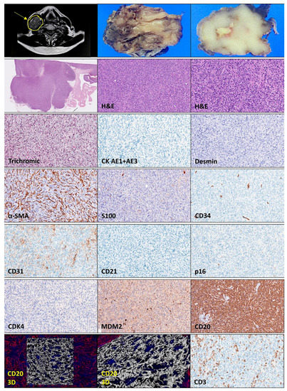 Mutational Profile and Pathological Features of a Case of Interleukin ...