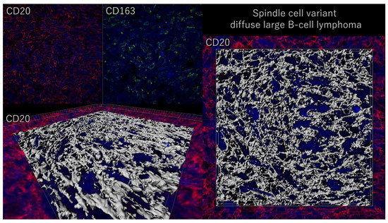 Mutational Profile and Pathological Features of a Case of Interleukin ...