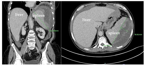 Splenic Rupture Secondary to Amyloidosis: A Case Report and Review of ...