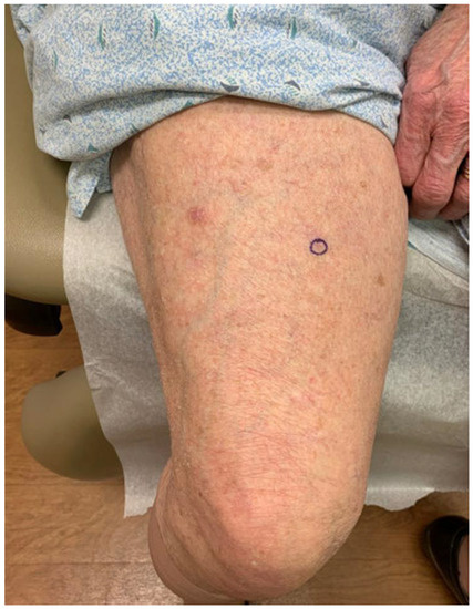 Cd5 Primary Cutaneous Diffuse Large B Cell Lymphoma Leg Type Presenting As An Asymptomatic Nodule