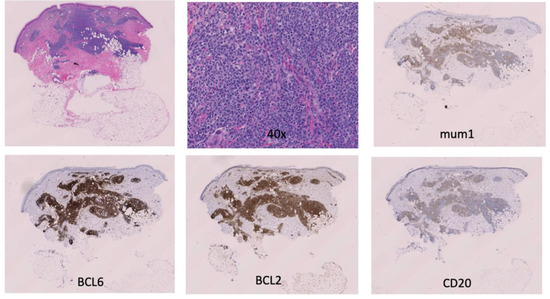 CD5+ Primary Cutaneous Diffuse Large B-Cell Lymphoma, Leg Type ...