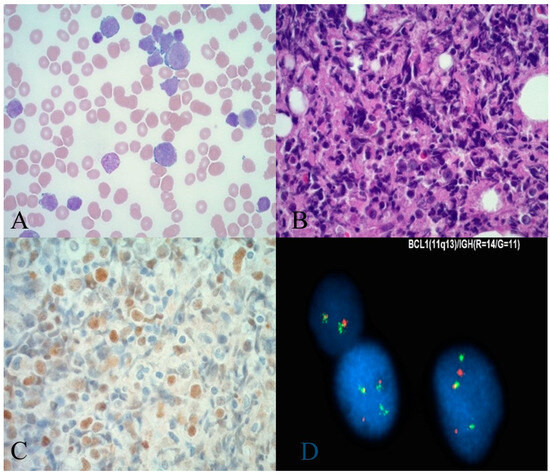 A Push to Consider Mantle Cell Lymphoma in Adults with Leukemia ...