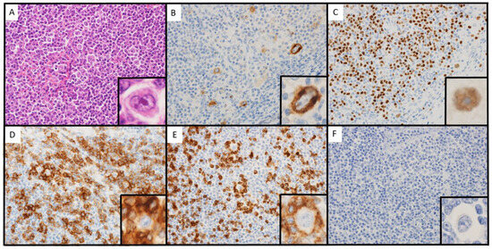 Angioimmunoblastic T-Cell Lymphoma after Treatment of Classic Hodgkin ...