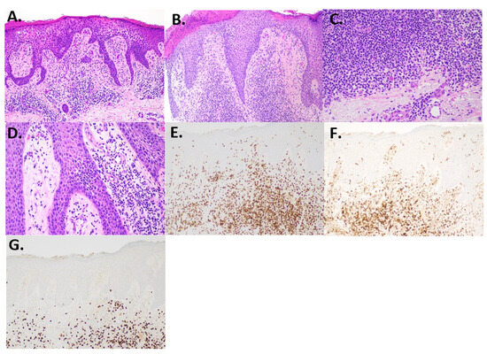 Cutaneous T-Cell Lymphoma (CTCL) Arising Post Kidney Transplant: A ...