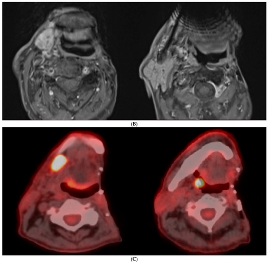 Is There an Association between a Tonsillar Diffuse Large B-Cell ...