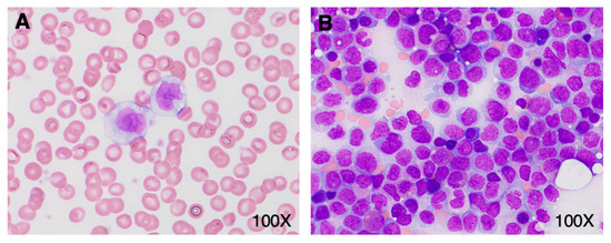 Morphological Clues of Acute Monocytic Leukemia in COVID-19-Induced ...