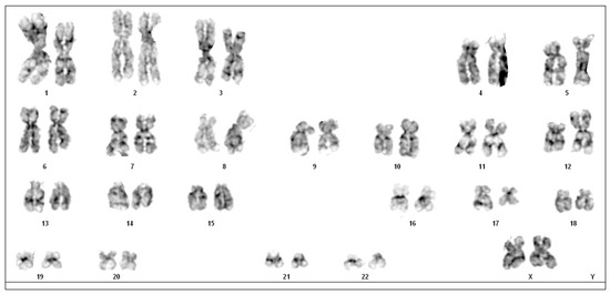 Hematology Reports | Free Full-Text | Three-Way Translocation t(12;15;17) (p13;q24;q21) Found in ...