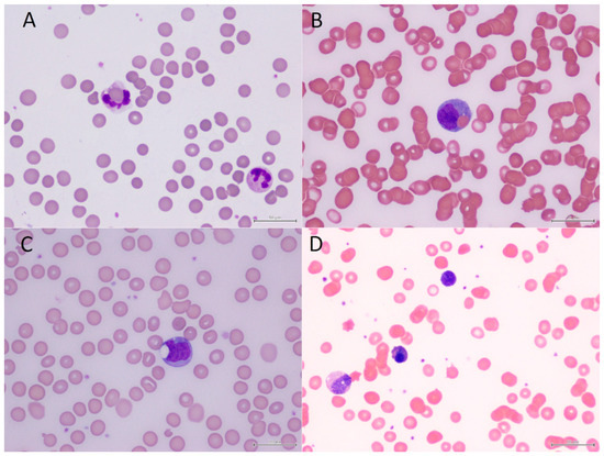 The Prevalence of Peripheral Erythrophagocytosis in Pediatric Immune ...