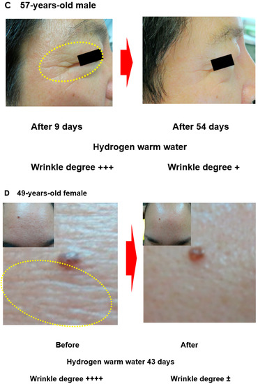 Repetitive Bathing and Skin Poultice with Hydrogen-Rich Water Improve ...