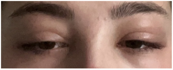 A Protracted Course of Periorbital Oedema in Infectious Mononucleosis ...