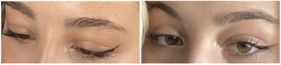 A Protracted Course of Periorbital Oedema in Infectious Mononucleosis ...