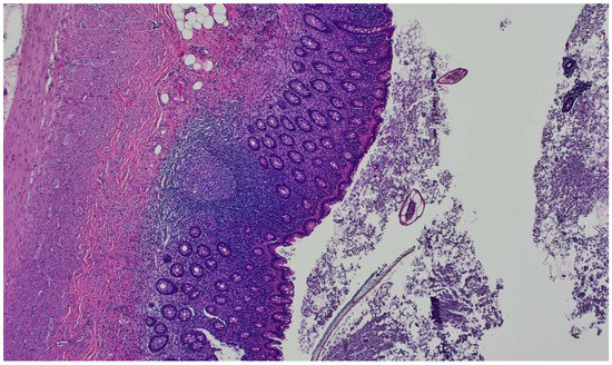 Enterobius vermicularis Related Acute Appendicitis: A Case Report and ...