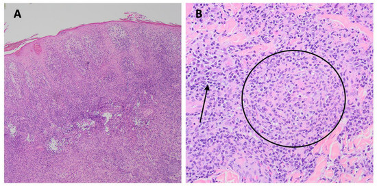 An Exuberant Case of Ulceronodular-Rupioid (Malignant) Syphilis in an ...