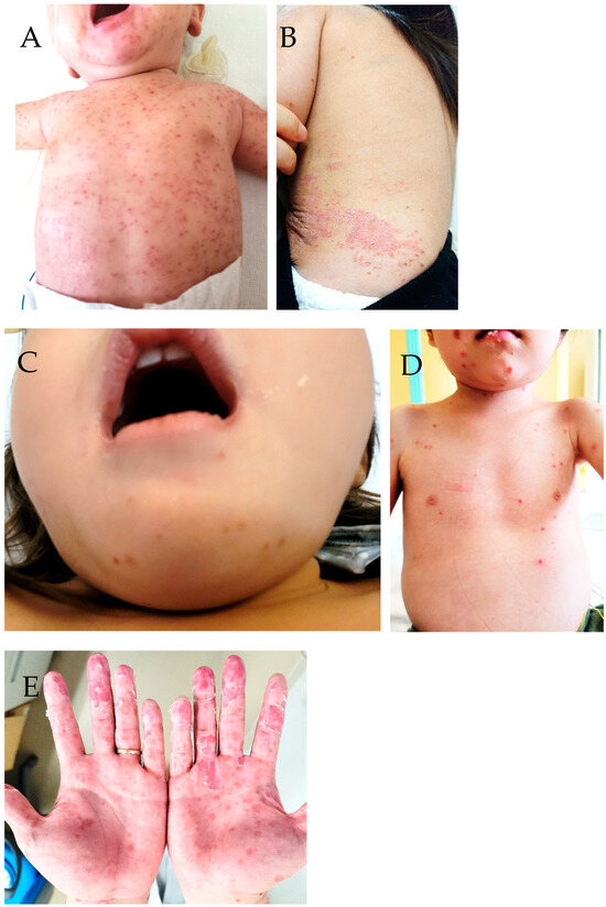 Clinical Features and Characteristics of Hand, Foot, and Mouth Disease ...