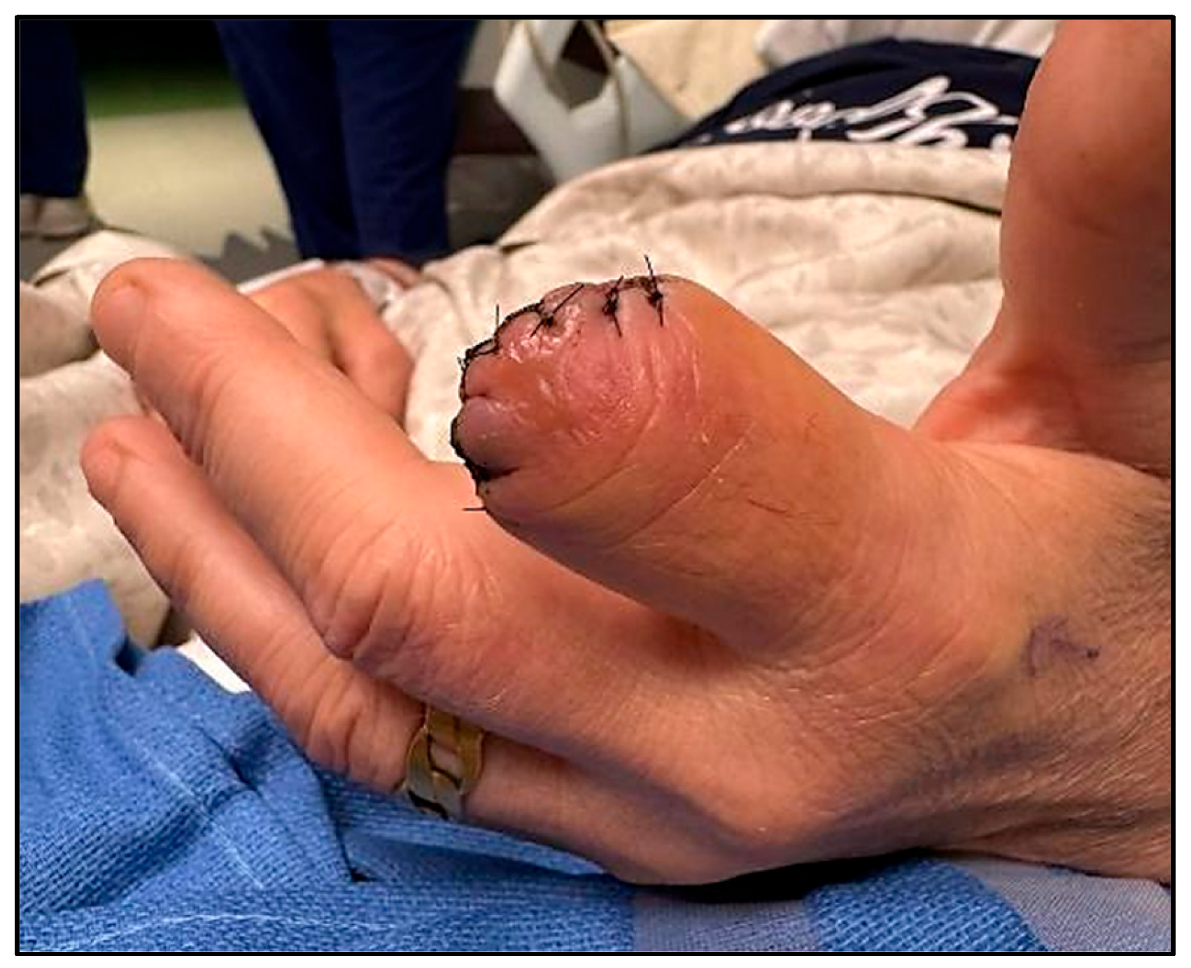 The First Schaalia (Formerly Actinomyces) Canis-Related Osteomyelitis ...