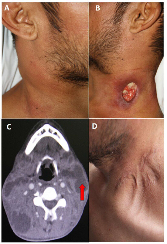 Scrofuloderma, an Old Acquaintance: A Case Report and Literature Review