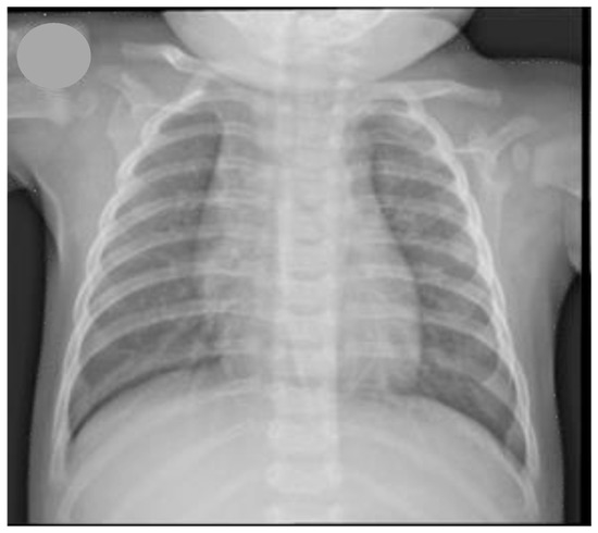 Role of High-Resolution Chest Computed Tomography in a Child with ...