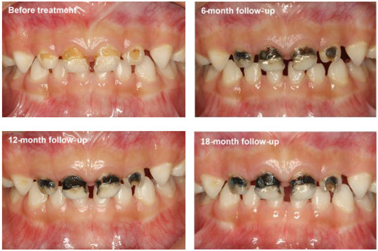 Revitalising Silver Nitrate for Caries Management