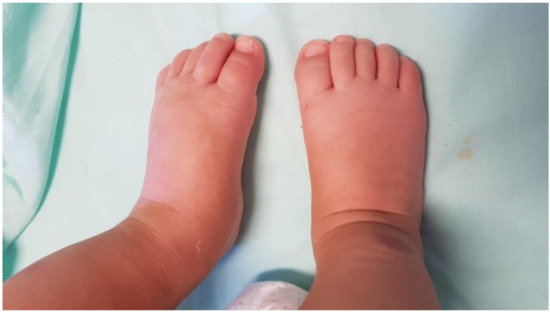 Targetoid Skin Lesions in a Child: Acute Hemorrhagic Oedema of Infancy ...