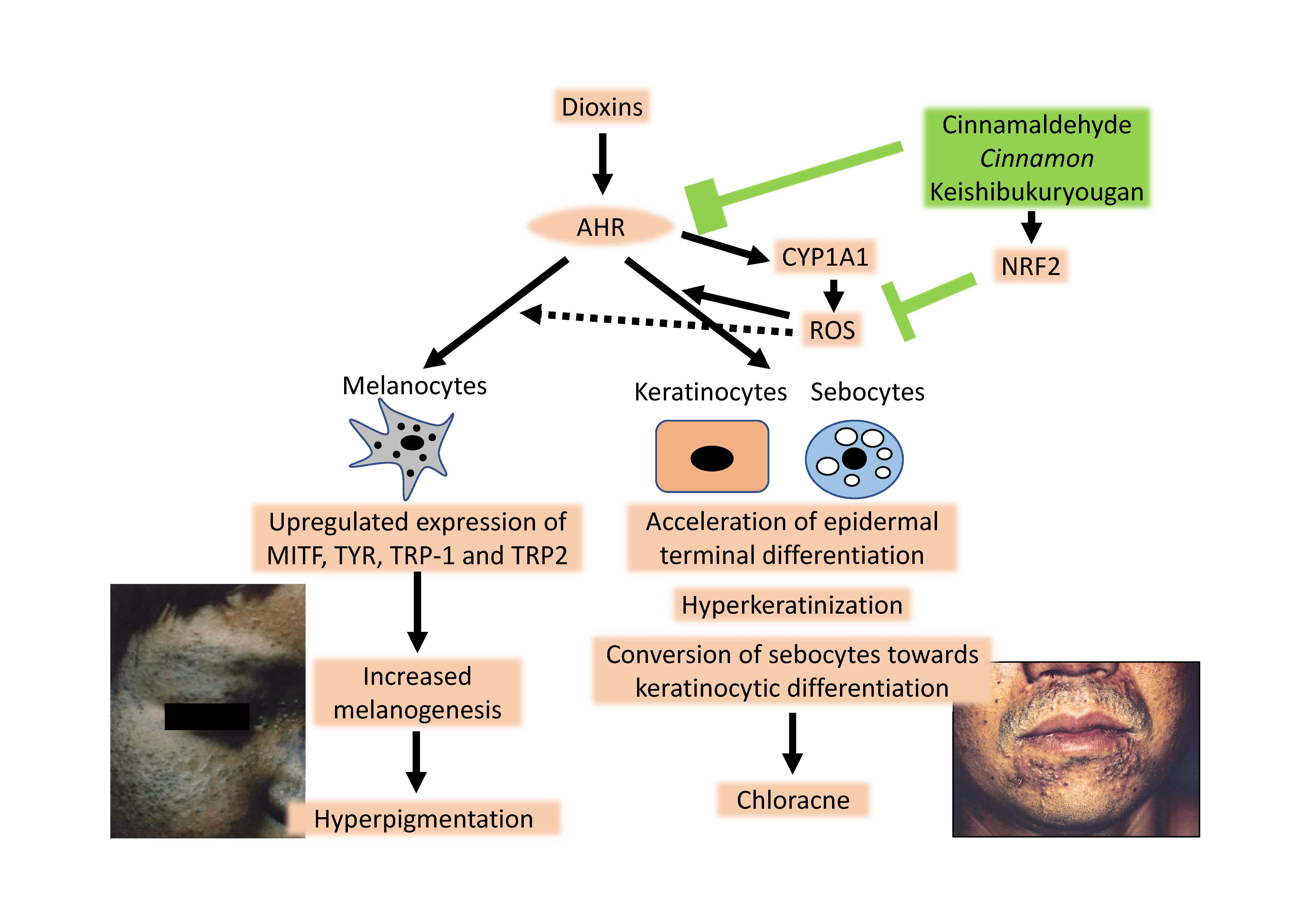 IJERPH | Free Full-Text | Chloracne and Hyperpigmentation Caused by ...