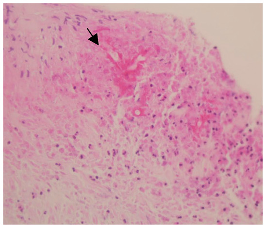Invasive Basidiobolomycosis Presenting as Retroperitoneal Fibrosis: A ...