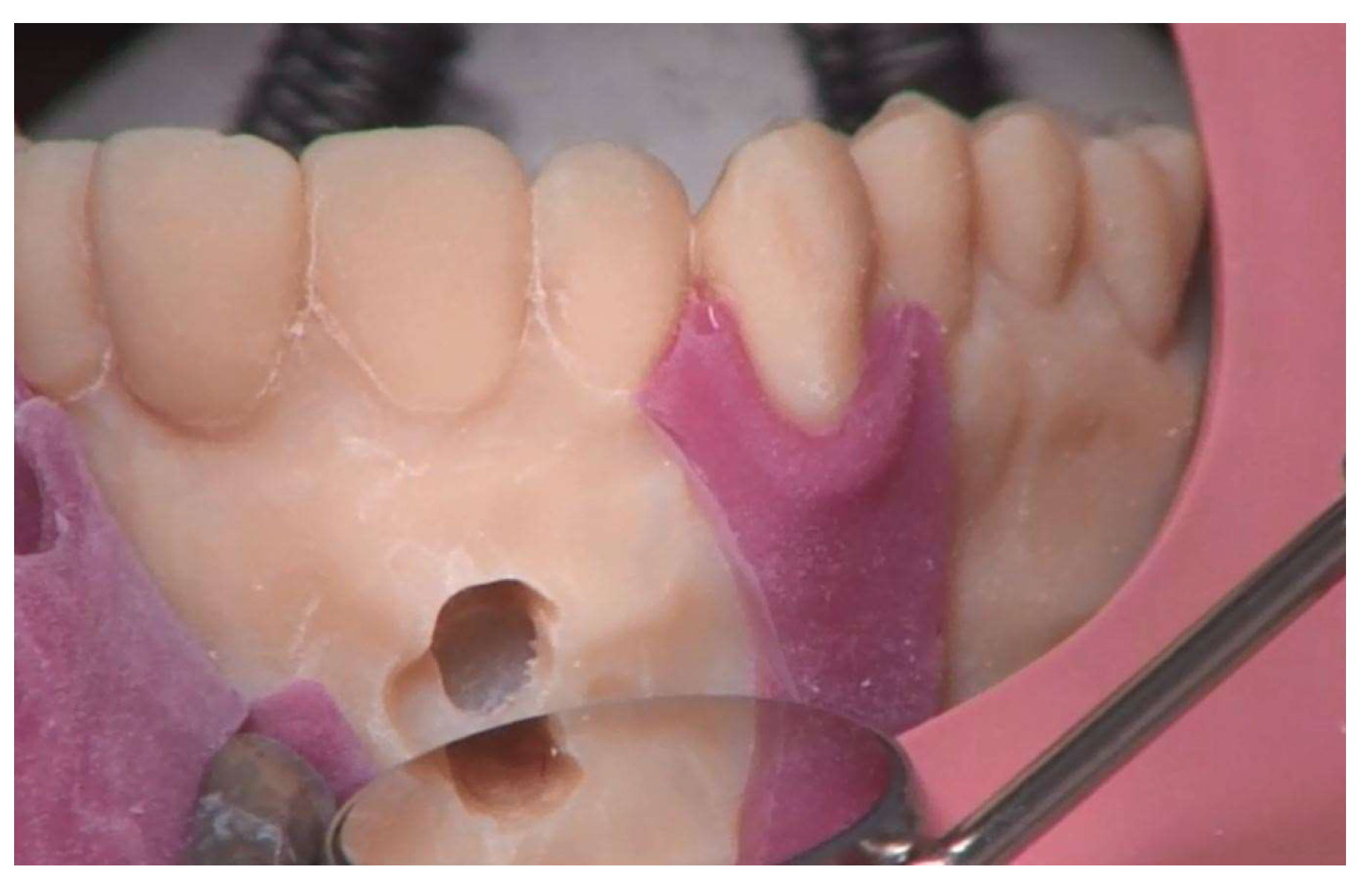 3D-printed Surgical Training Model Based on Real Patient Situations for ...