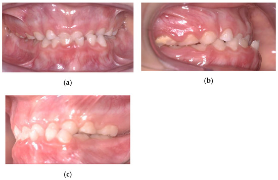 Early Treatment of Anterior Crossbite with Eruption Guidance Appliance ...