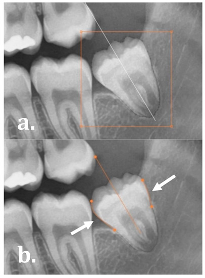 Artificial Intelligence (AI)-Driven Molar Angulation Measurements to ...