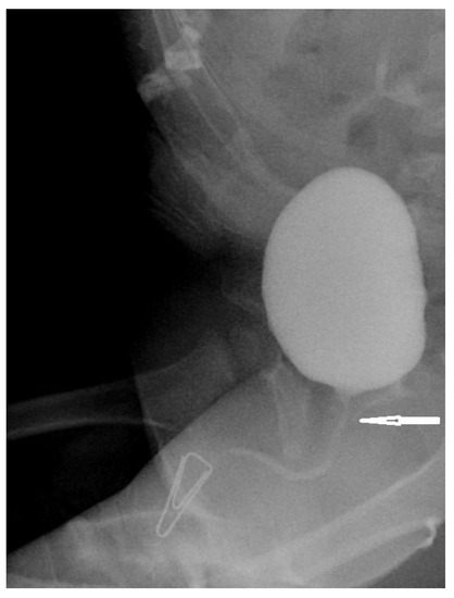Early Feminizing Genitoplasty in Girls with Congenital Adrenal ...