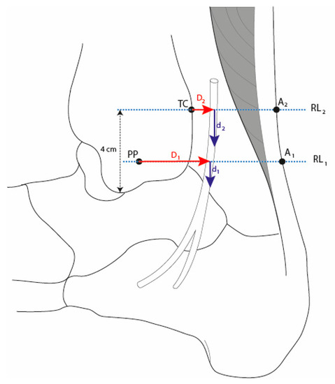 Tibial Nerve Block: Supramalleolar or Retromalleolar Approach? A ...