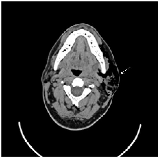 Pneumoparotid and Pneumoparotitis: A Literary Review