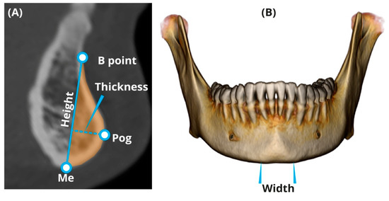 Variation in Chin and Mandibular Symphysis Size and Shape in Males and ...