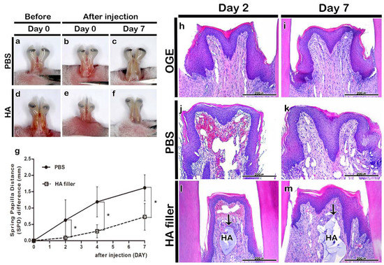 Effect of Hyaluronic Acid Filler Injection on the Interdental Papilla ...