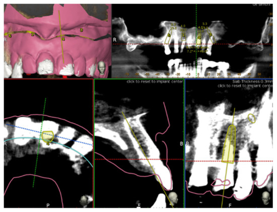 Accuracy of Dynamic Navigation System Workflow for Implant Supported Full Arch Prosthesis: A ...