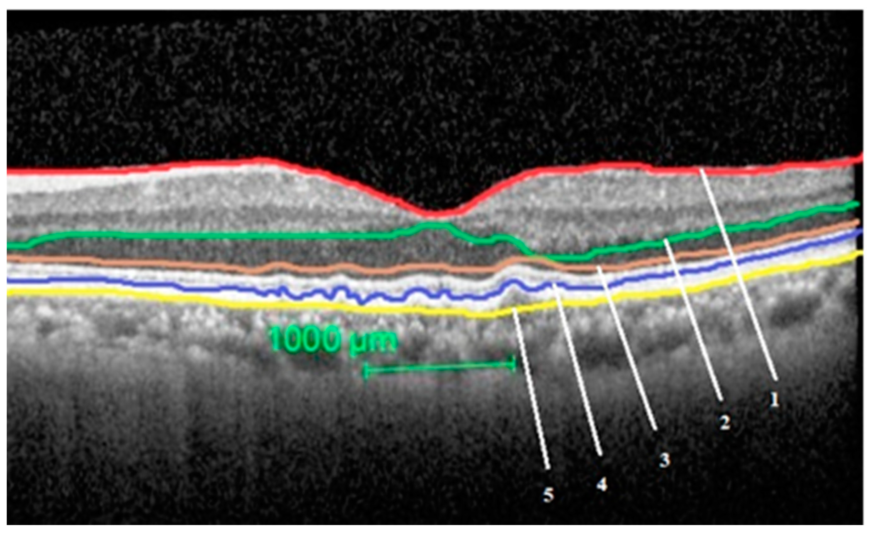 Correlation between Visual Functions and Retinal Morphology in Eyes ...