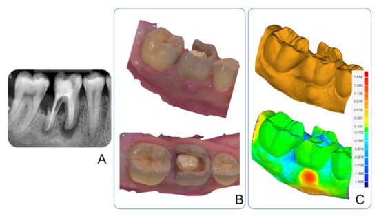 Monitoring Alveolar Ridge Remodelling Post-Extraction Using Sequential ...