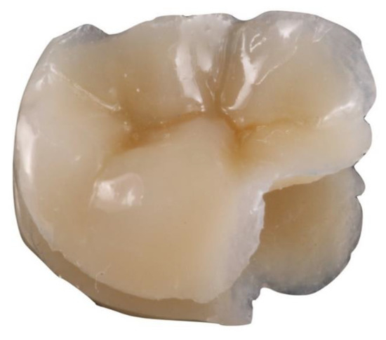 Clinical Behavior of Ceramic, Hybrid and Composite Onlays. A Systematic ...