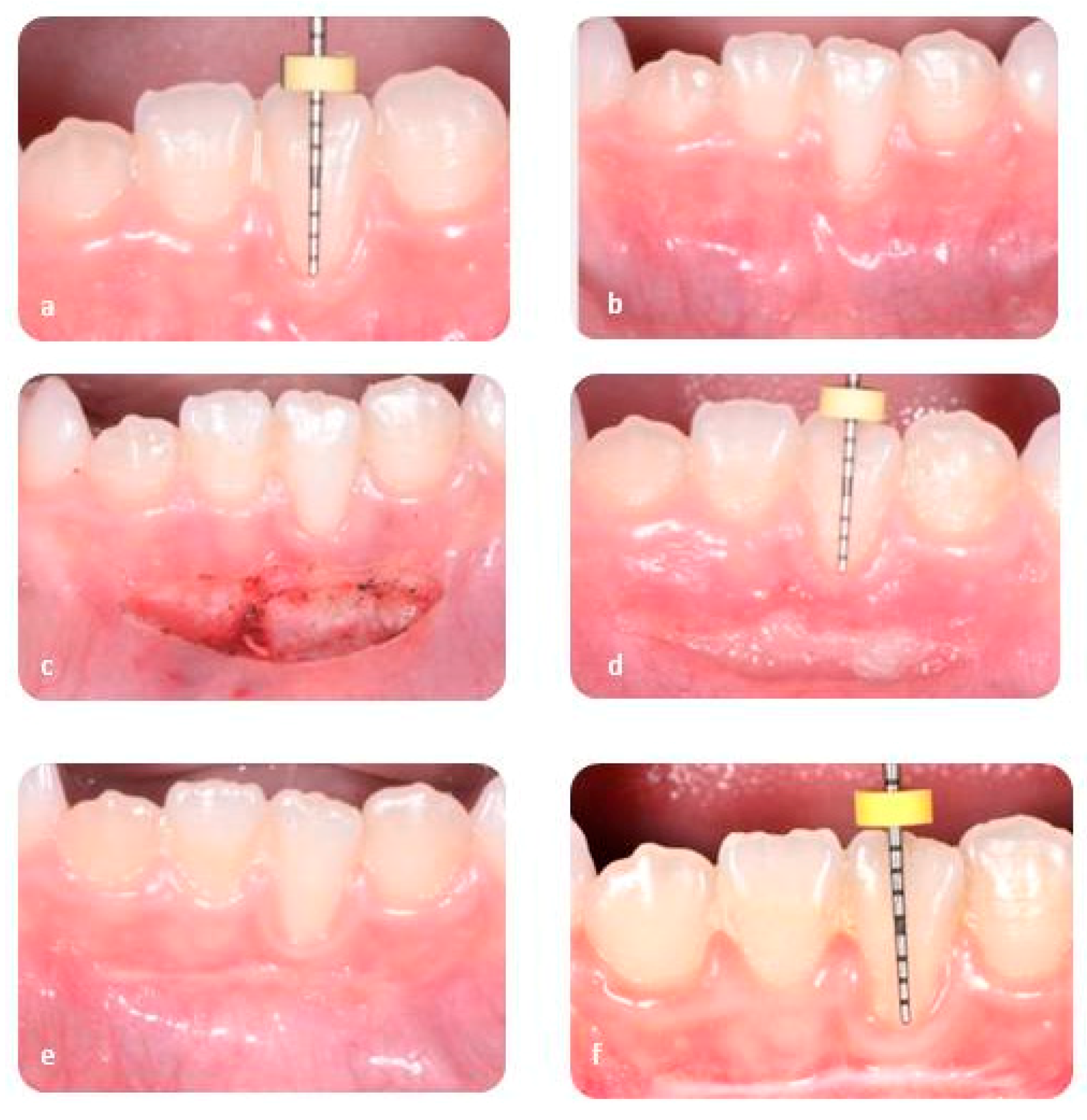 IJERPH | Free Full-Text | Diode versus CO2 Laser Therapy in the Treatment of High Labial ...