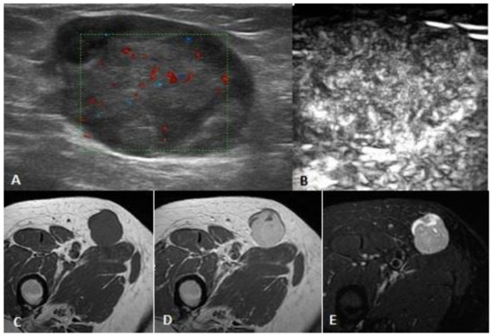 Small Subcutaneous Soft Tissue Tumors