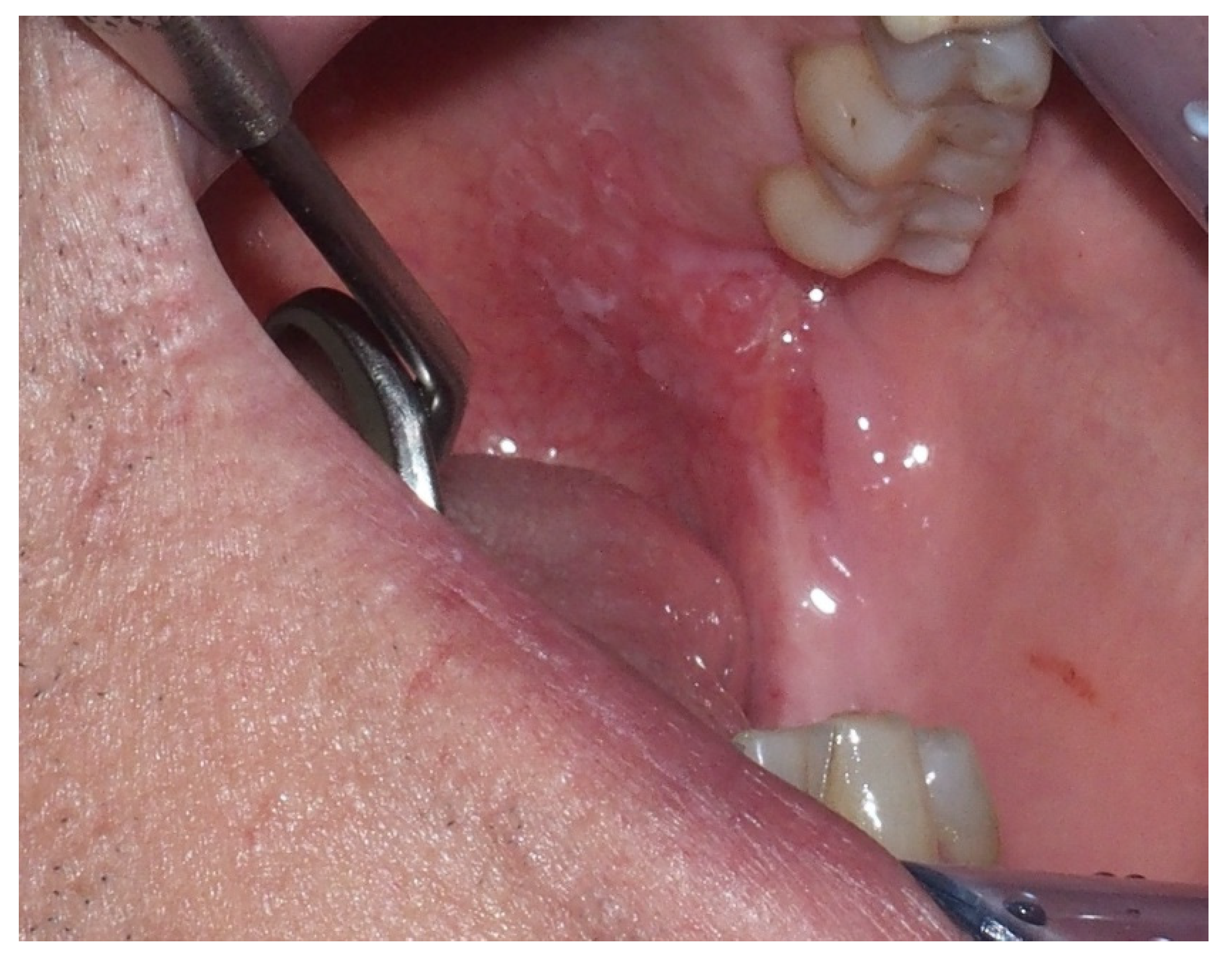 Ijerph Free Full Text Oral Cancer And Precancer A Narrative Review