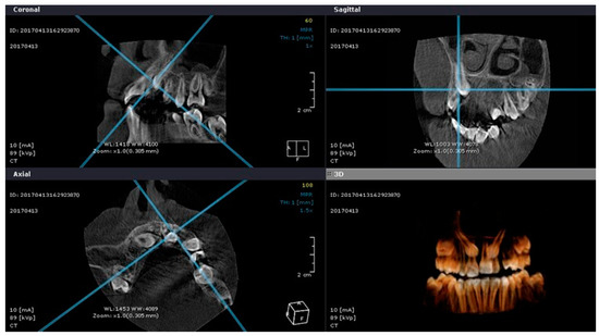 CBCT and Intra-Oral Scanner: The Advantages of 3D Technologies in ...