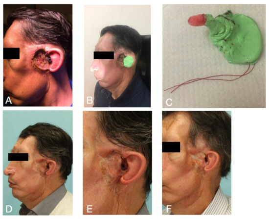 IJERPH | Free Full-Text | Is Biofeedback through an Intra-Aural Device ...