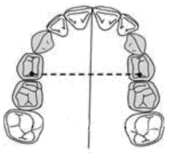 Transverse Asymmetries of the Maxilla Even in Healthy and Apparently ...