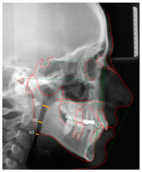 Influence of Fixed Orthodontic Therapy on Pharyngeal Airway Dimensions ...