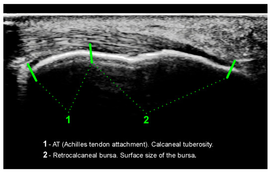 Surface Shape of the Calcaneal Tuberosity and the Occurrence of ...