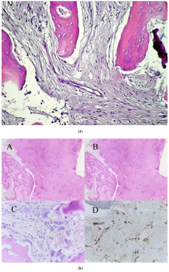 An Orthodontic Approach for Garre’s Sclerosing Osteomyelitis of the ...