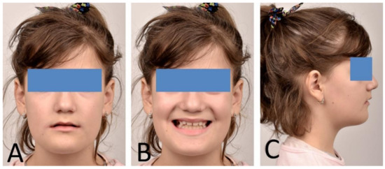 An Orthodontic Approach for Garre’s Sclerosing Osteomyelitis of the ...