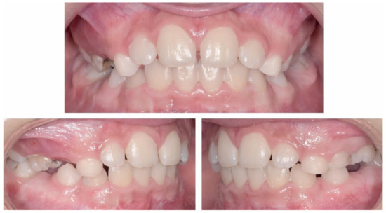 IJERPH | Free Full-Text | An Orthodontic Approach for Garre’s ...