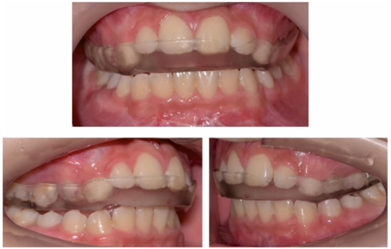 An Orthodontic Approach for Garre’s Sclerosing Osteomyelitis of the ...