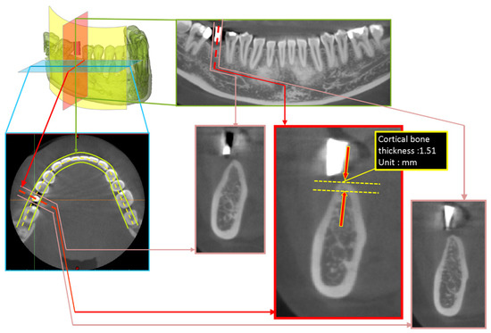 Can Male Patient’s Age Affect the Cortical Bone Thickness of Jawbone ...